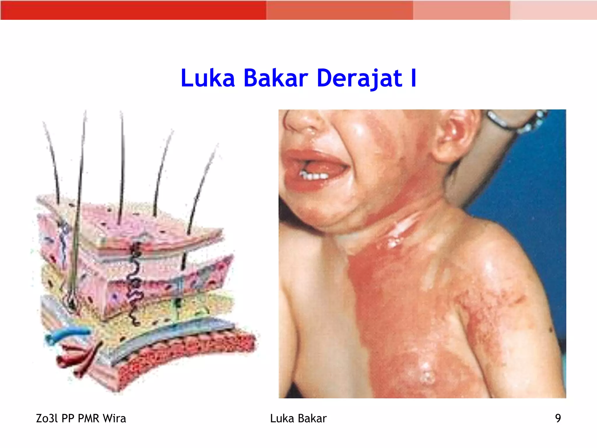 6. Luka Bakar.ppt
