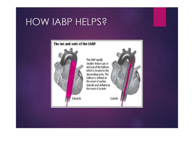 Intra Aortic Balloon Pump - All you need to know | PPTX