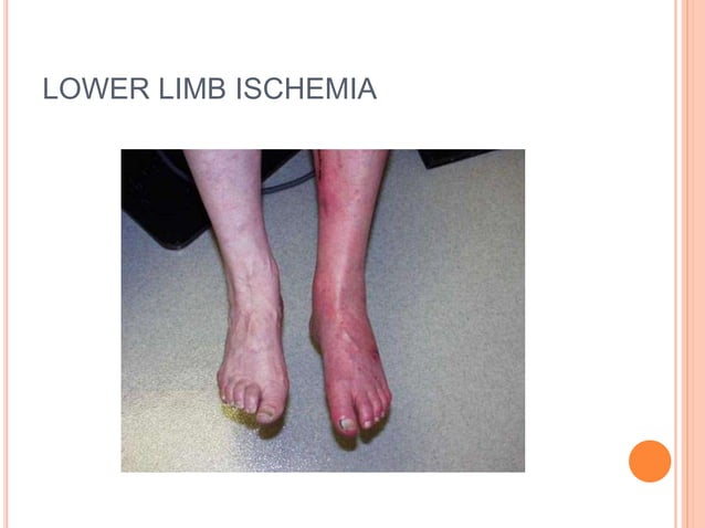 6.pathology of upperlimb & lower limb arterial system.pptx | Diseases ...