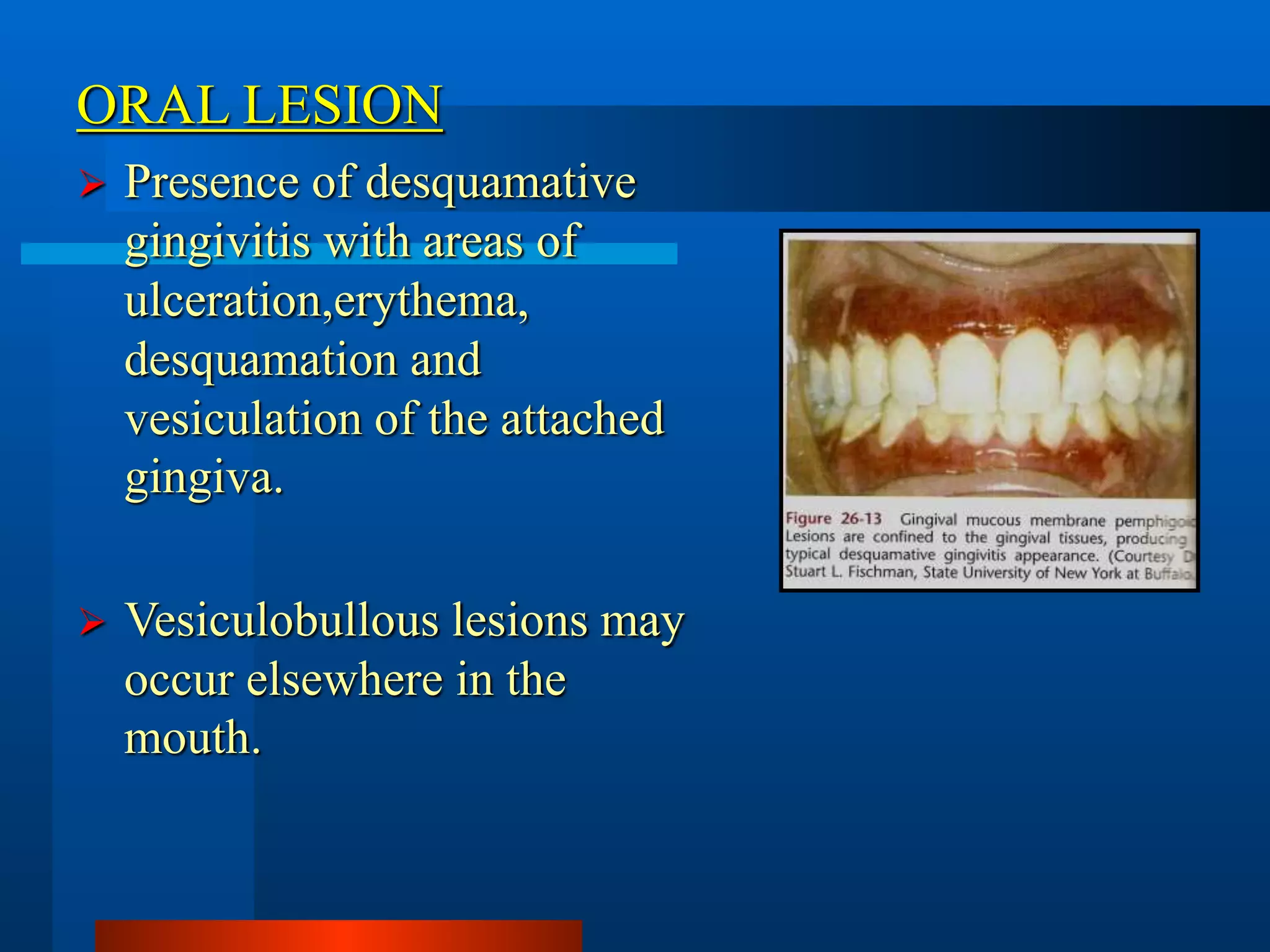 6.desquamative gingivitis.ppt
