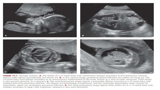 6. Fetal Disorders.pptx