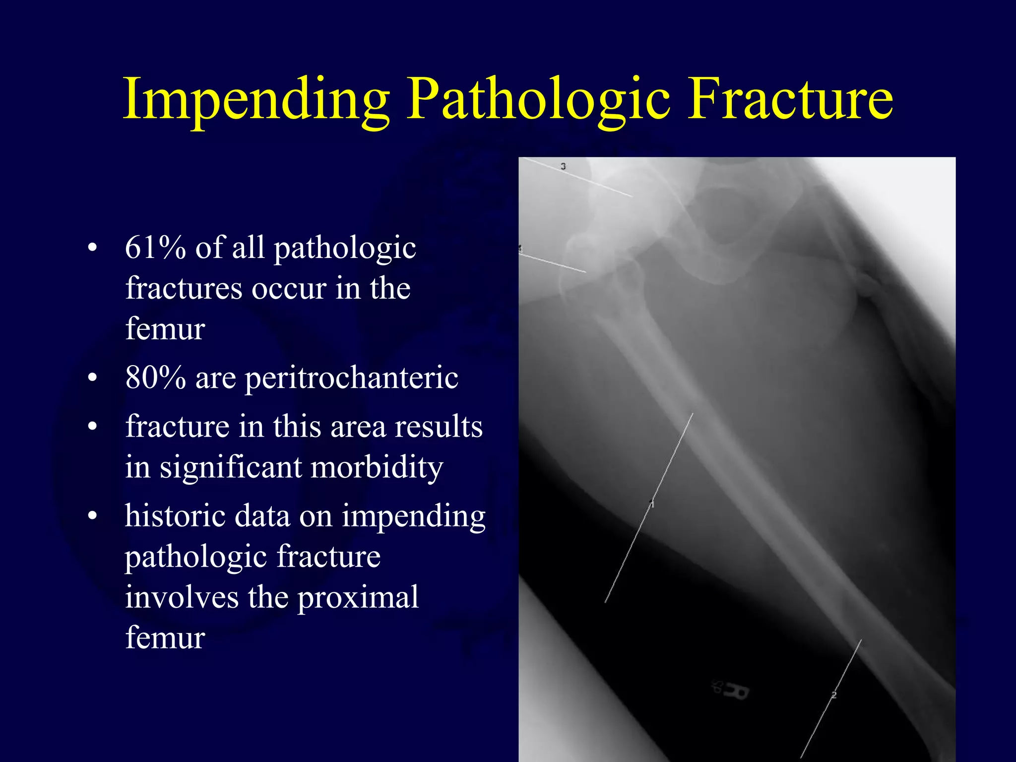Pathologic Fractures orthopedics trauma | PPT | Cancer | Diseases and ...