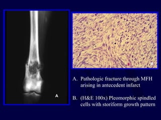 Pathologic Fractures orthopedics trauma | PPT