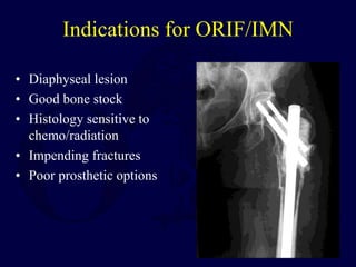 Pathologic Fractures orthopedics trauma | PPT