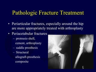 Pathologic Fractures orthopedics trauma | PPT