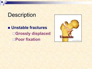 6. biomechanics of Fracture fixation 1.ppt