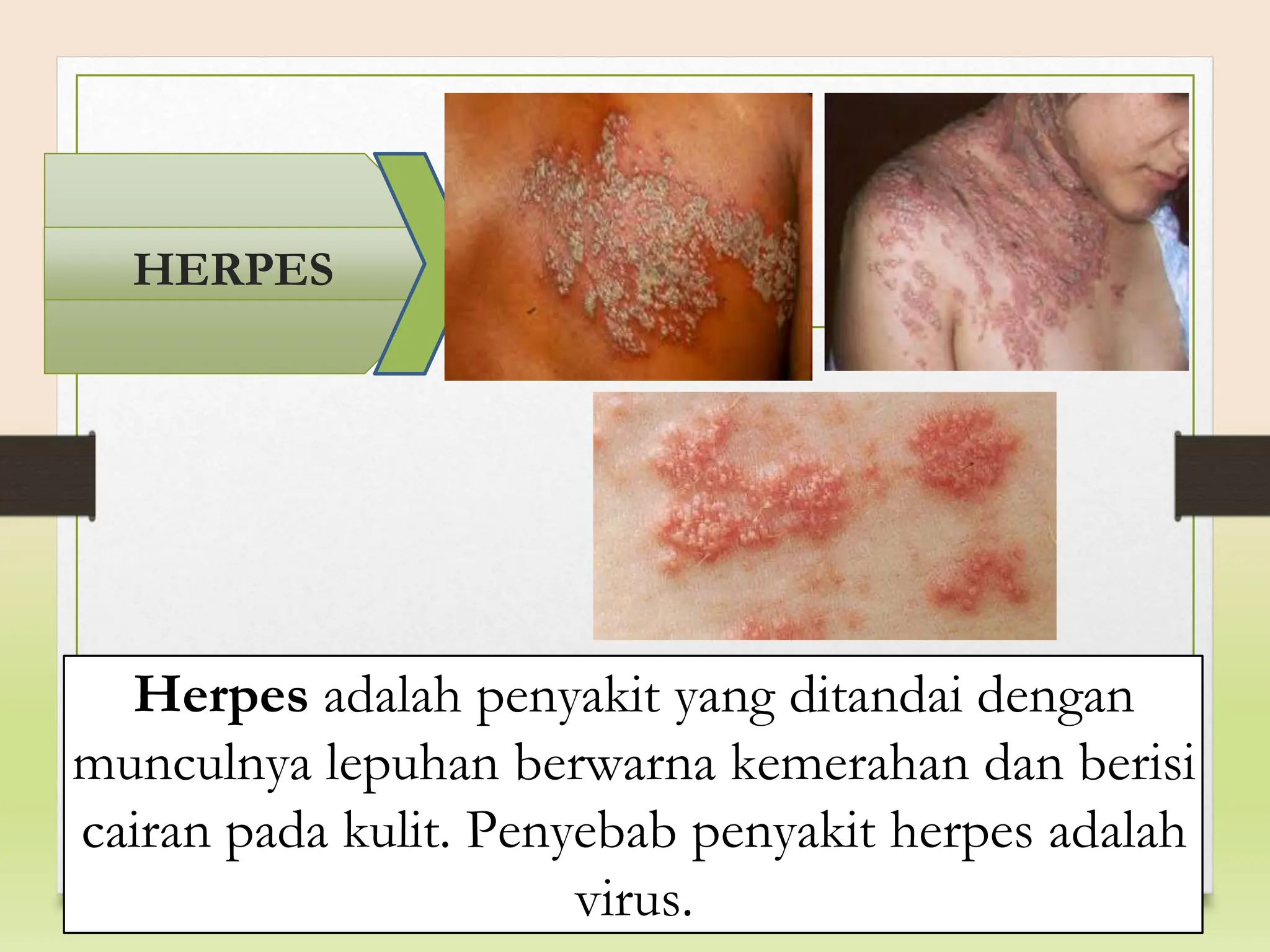 Herpes Penyakit Menular Seksual.....pptx