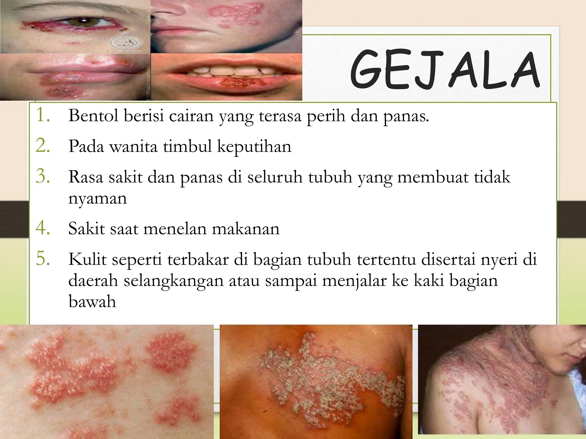 Herpes Penyakit Menular Seksual.....pptx