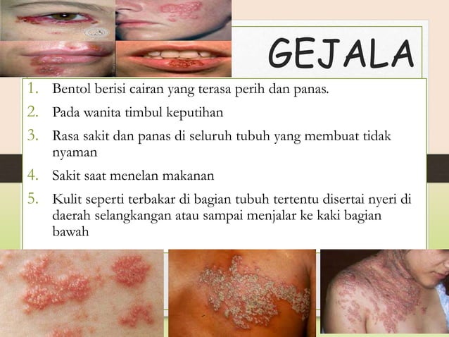 Herpes Penyakit Menular Seksual.....pptx