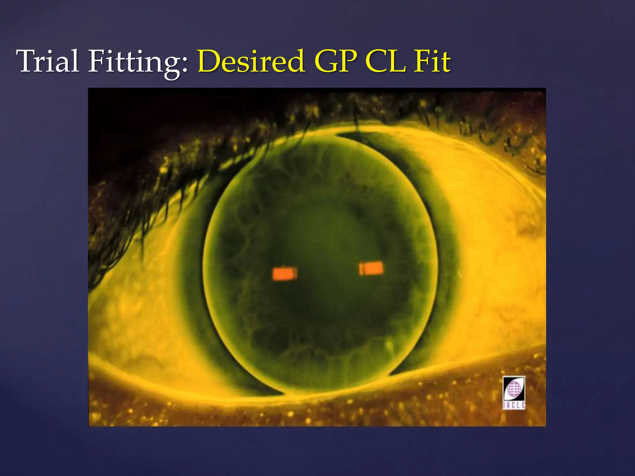 6. Pre-fitting Assessment of rgp lens.ppt
