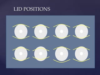 6. Pre-fitting Assessment of rgp lens.ppt