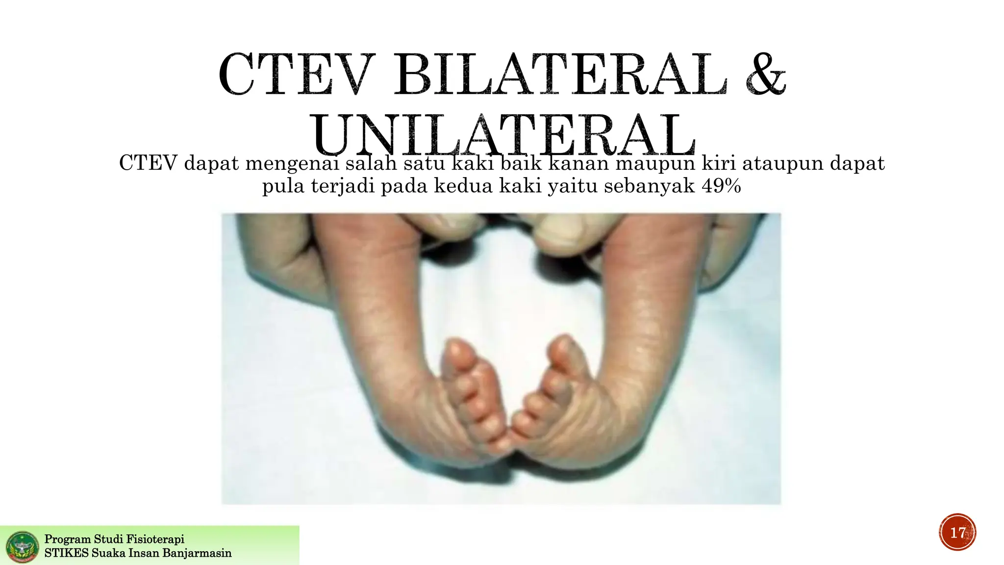 FISIOTERAPI PEDIATRI PADA KASUS - CTEV.pptx