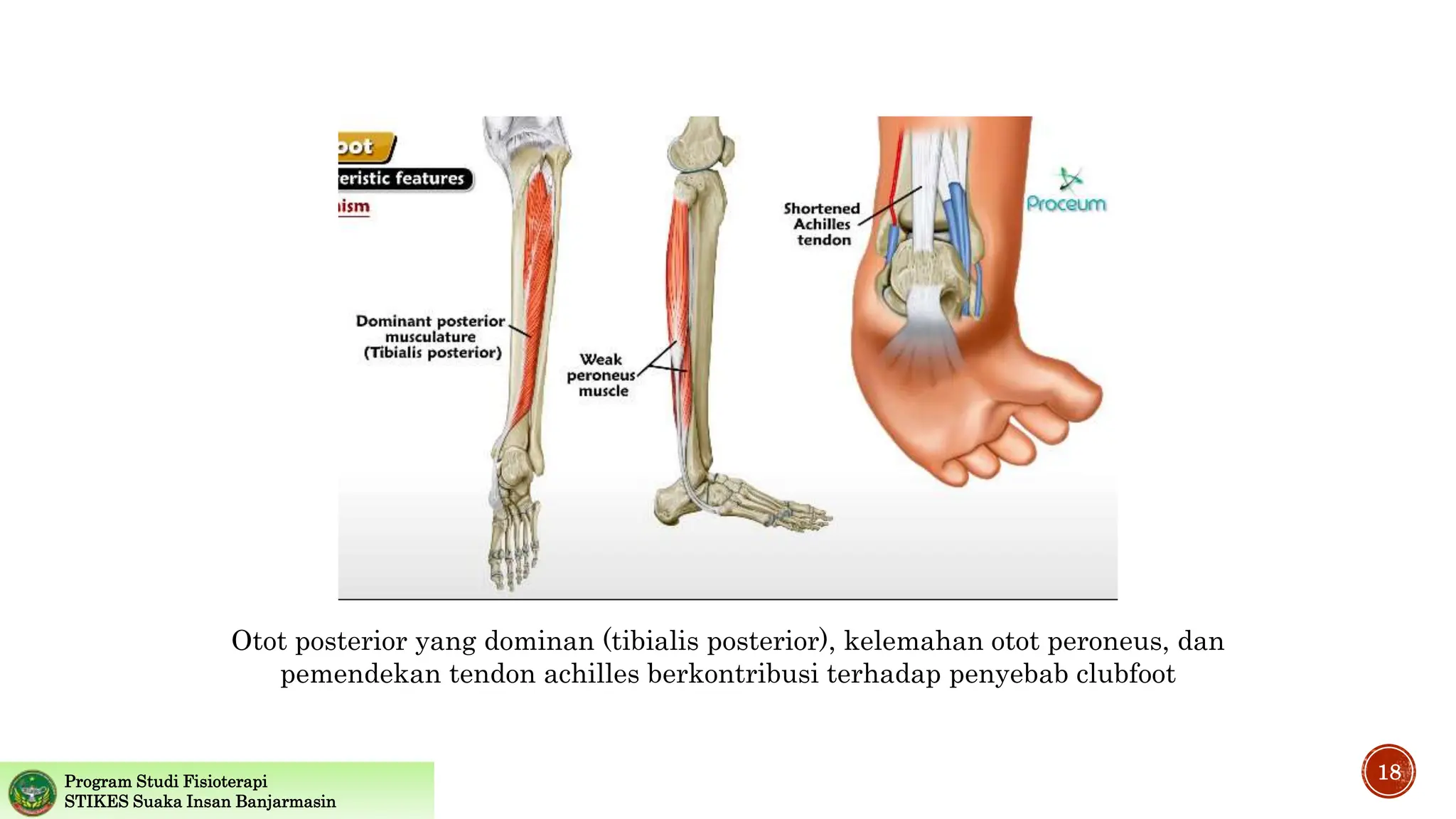 FISIOTERAPI PEDIATRI PADA KASUS - CTEV.pptx