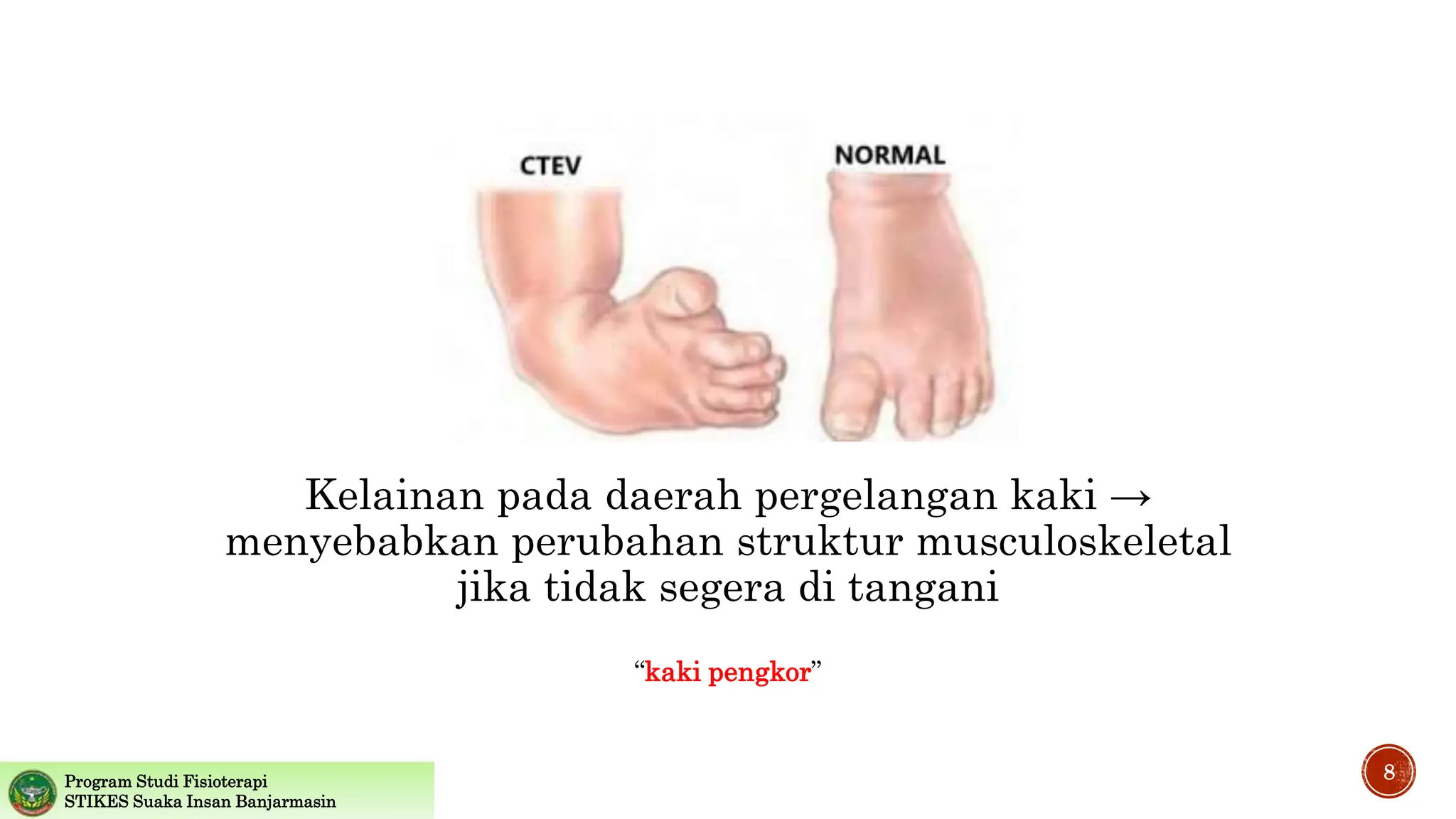 FISIOTERAPI PEDIATRI PADA KASUS - CTEV.pptx
