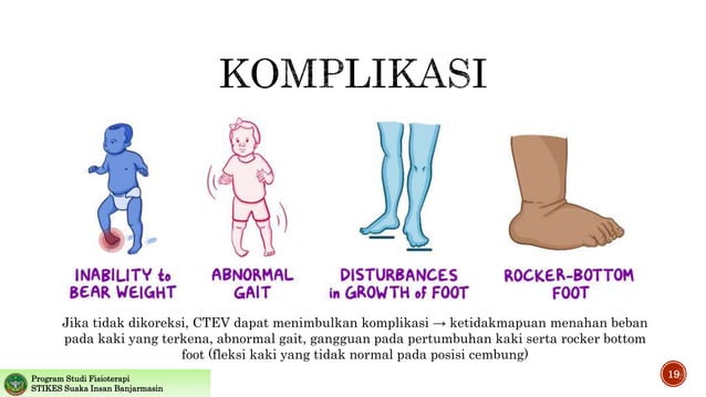 FISIOTERAPI PEDIATRI PADA KASUS - CTEV.pptx