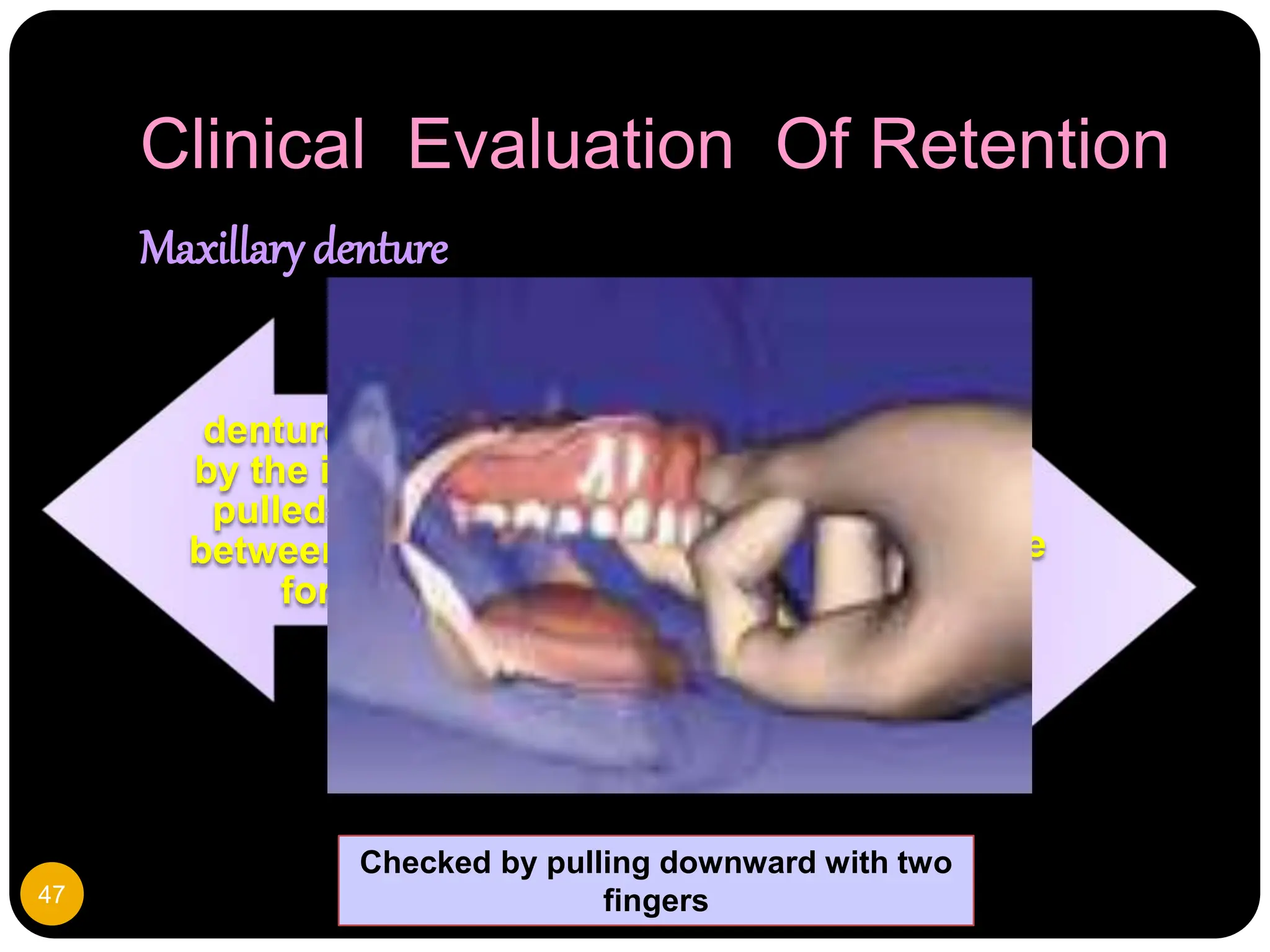6.Retention, stability and support in complete denture.pptx