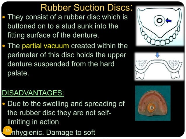 6.Retention, stability and support in complete denture.pptx | Oral care ...