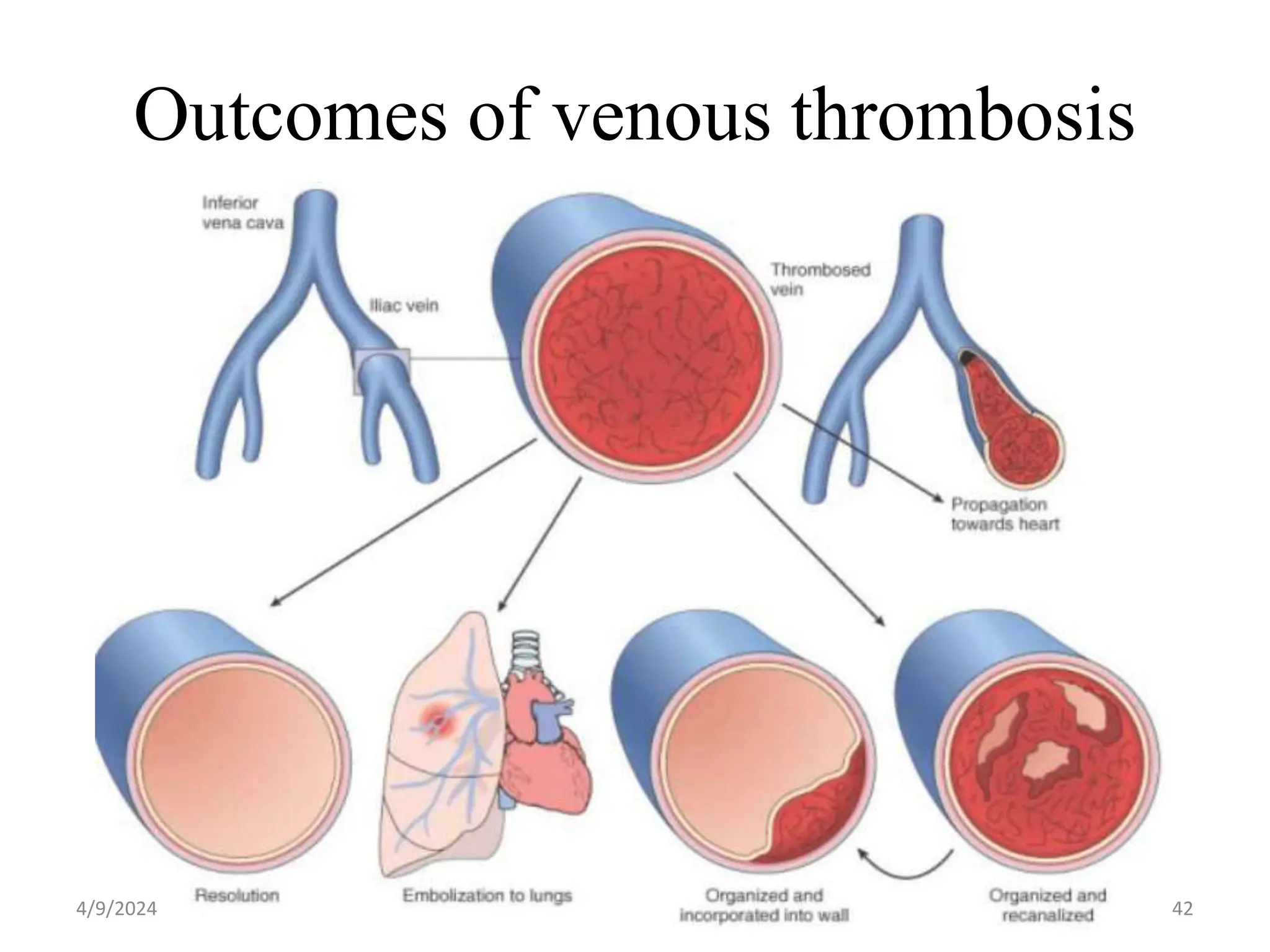 6. Hemodynamic Disorders, Thromboembolic Disease.pptx