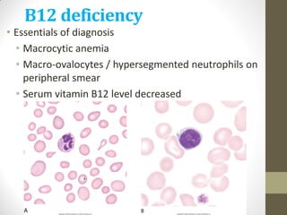 Anemia; causes, types, laboratory investigations | PDF