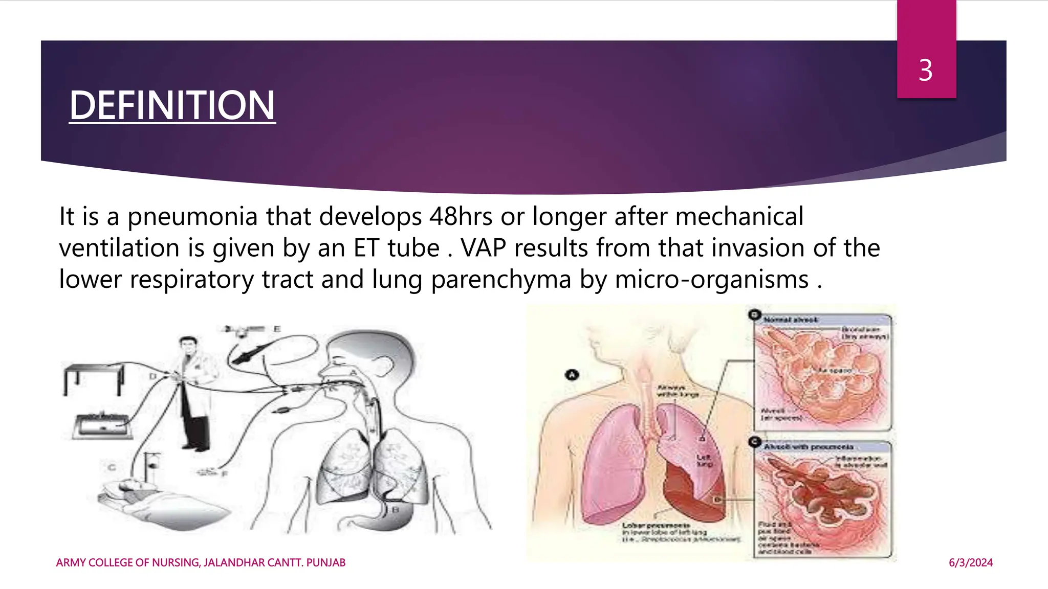 6. PREVENTION OF VAP and its treatment .pptx