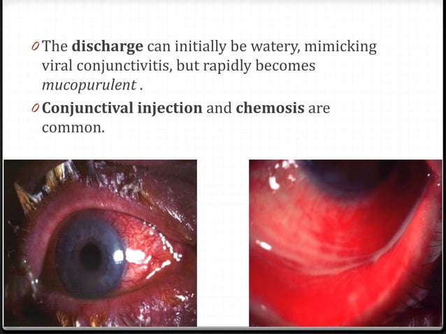 Red eye with Differentials and sample causes | PPT
