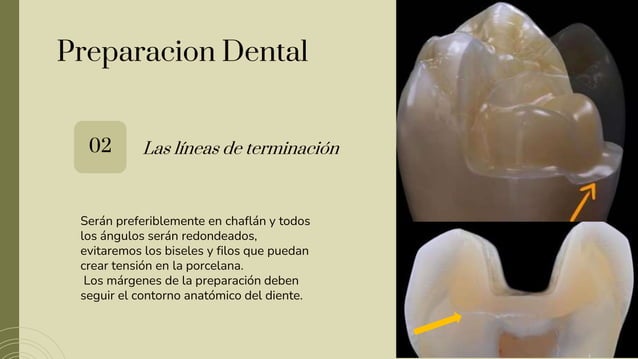6. Preparaciones Onlay y Overlay preparacion para incrustaciones .pptx