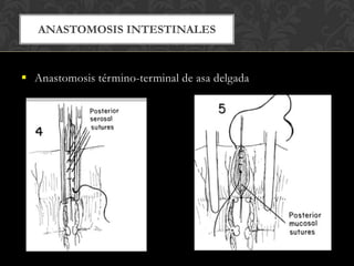 tecnicas de Anastomosis intestinales.ppt