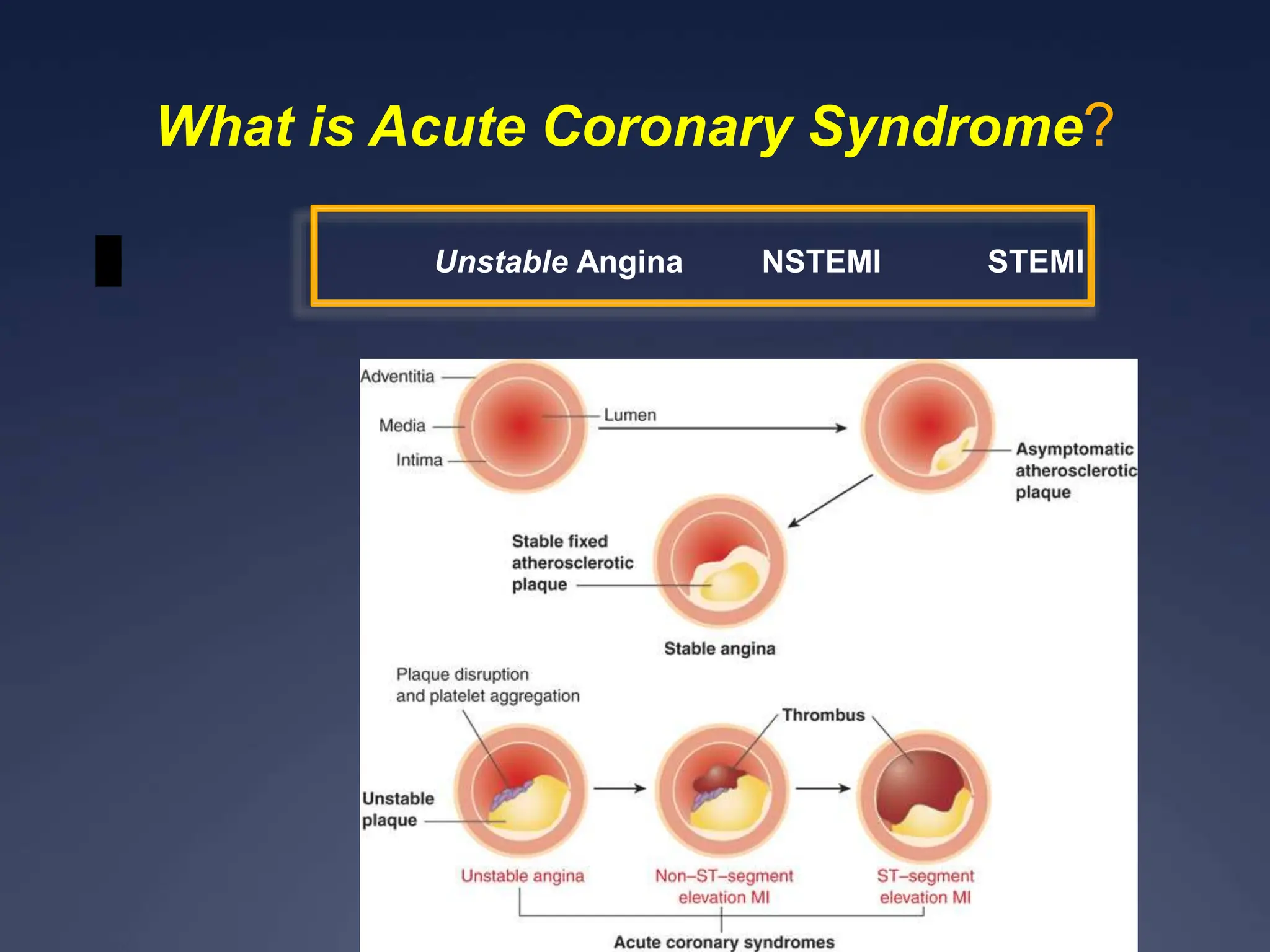Acute coronary syndromes Cardiovascular. | PPTX
