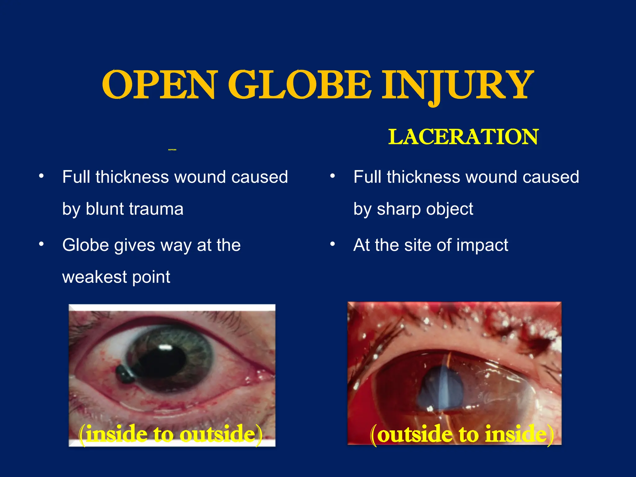Penetrating Eye Injuries - Introduction, types and Management | PPT