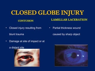 Penetrating Eye Injuries - Introduction, types and Management | PPT