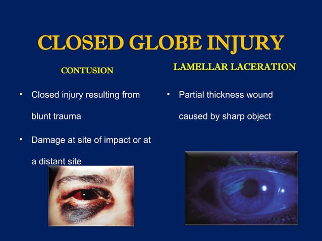 Penetrating Eye Injuries - Introduction, types and Management | PPT ...