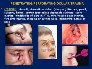 Penetrating Eye Injuries - Introduction, types and Management | PPT