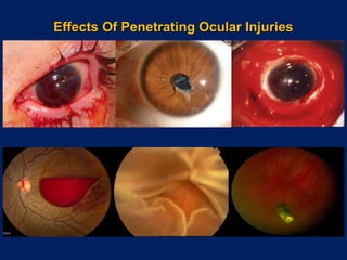 Penetrating Eye Injuries - Introduction, types and Management | PPT