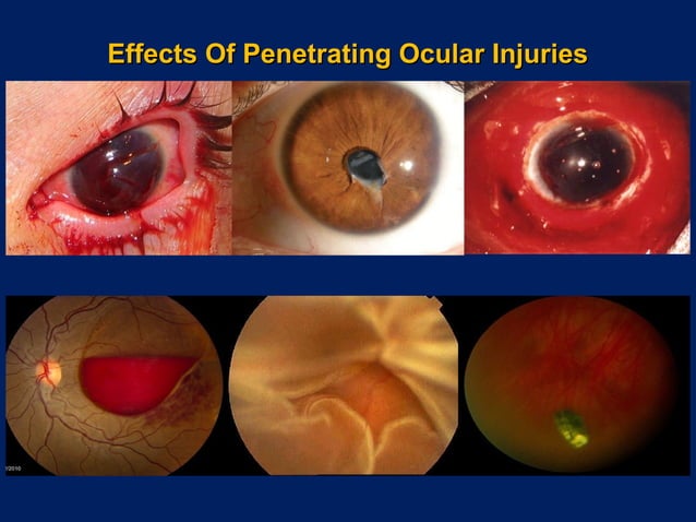 Penetrating Eye Injuries - Introduction, types and Management | PPT ...