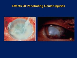 Penetrating Eye Injuries - Introduction, types and Management | PPT