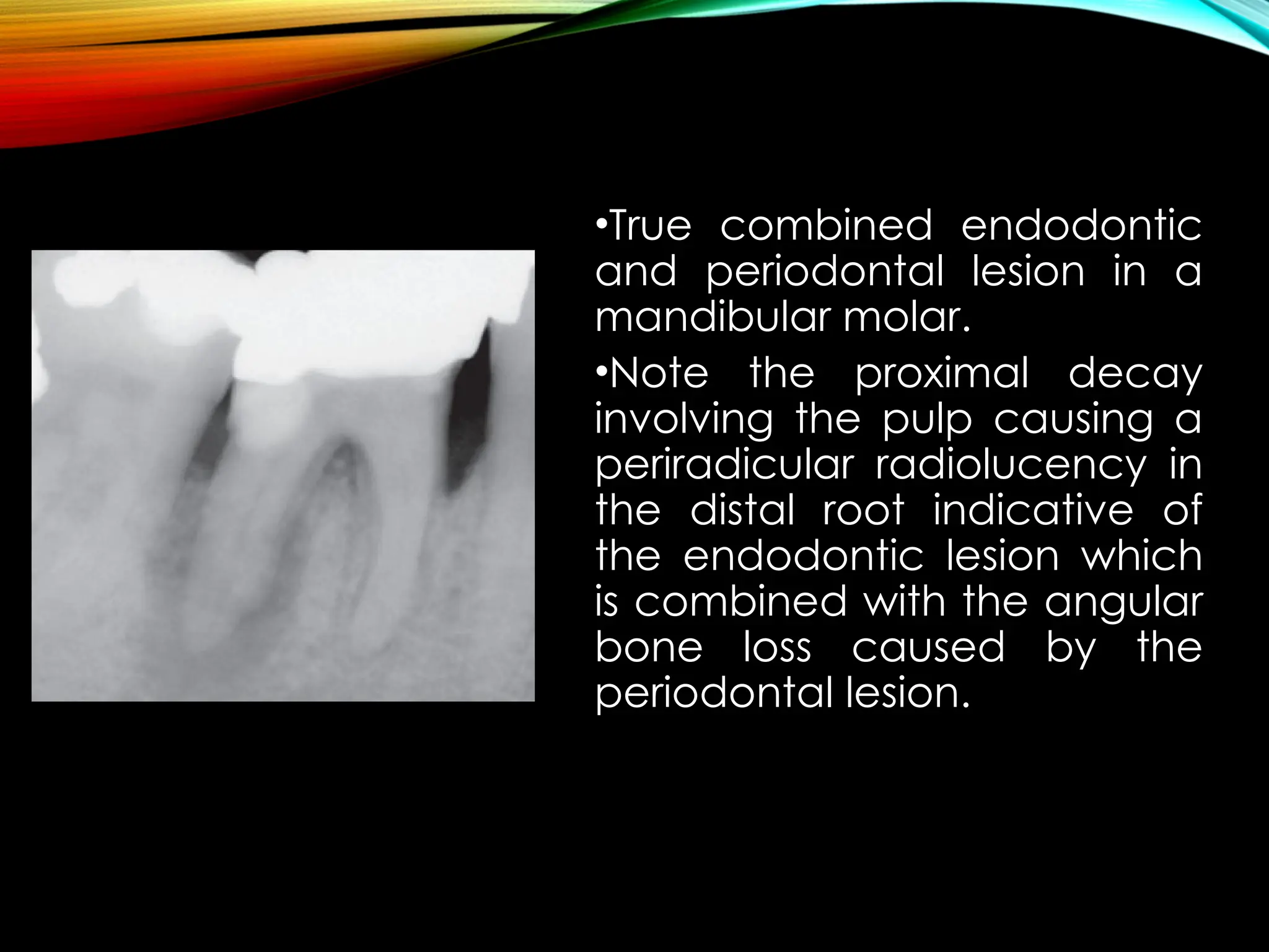 endo perio lesions diagnosis and management | PPTX