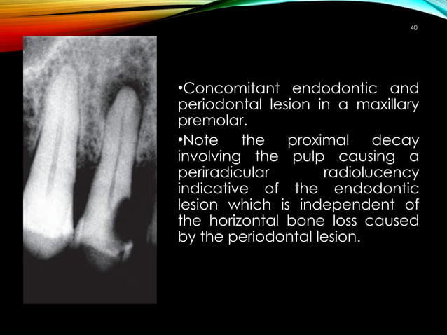 endo perio lesions diagnosis and management | PPTX | Dental Health ...