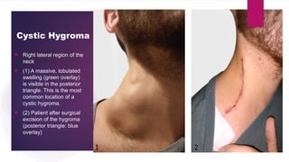 6. CONGENITAL NECK MASSES.pptx23333455678 | PPTX