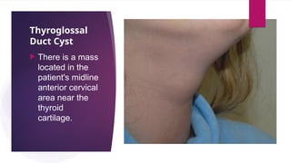 6. CONGENITAL NECK MASSES.pptx23333455678 | PPTX