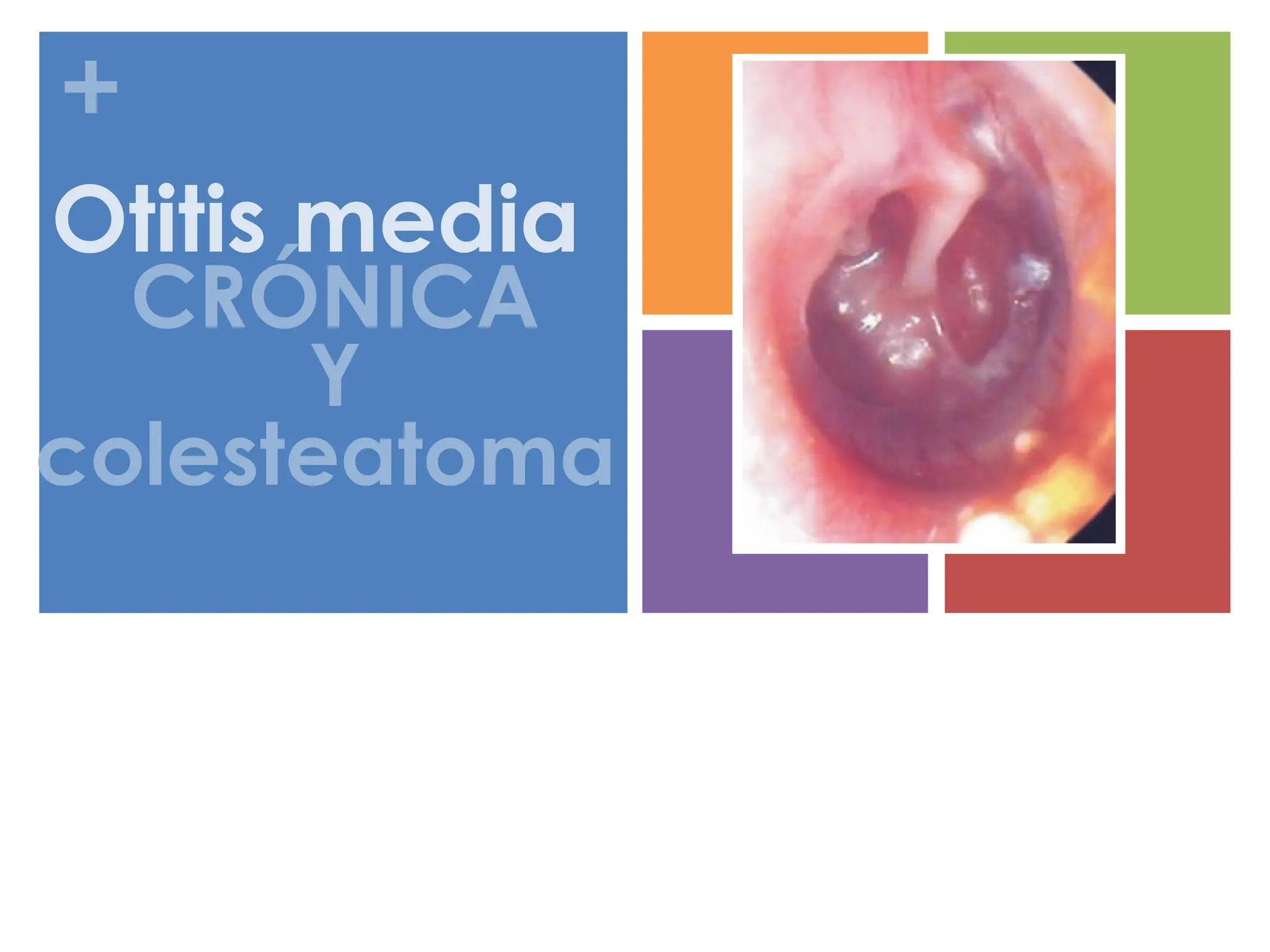 6.- Otitis Media Crónica y colesteatoma.pptx
