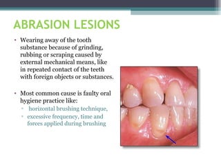non carious lesion and their managrment tooth structure loss can not be ...