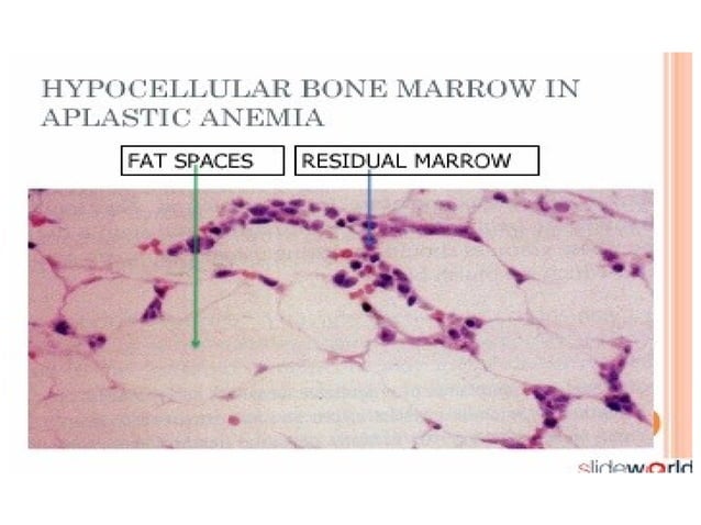 Aplastic Anemia lecture slides in hematology | PPT