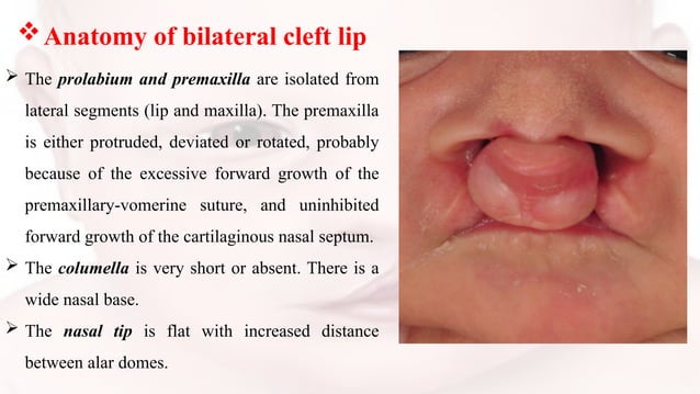 Surgical anatomy of Cleft lip- maxillofacial surgery | PPTX | Ear, Nose and Throat Conditions ...