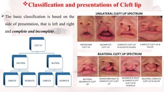 Surgical anatomy of Cleft lip- maxillofacial surgery | PPTX | Ear, Nose and Throat Conditions ...