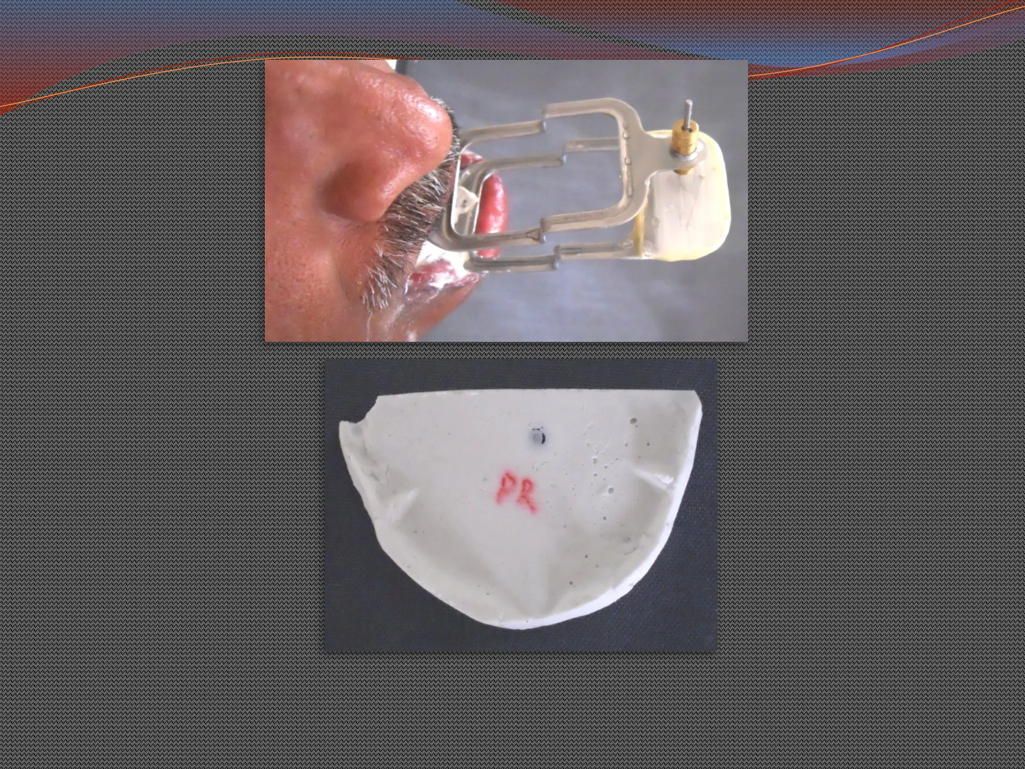 Gothic arch tracing.complete denture denture | PPT
