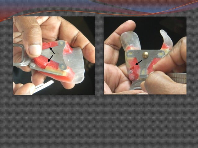 Gothic arch tracing.complete denture denture | PPT