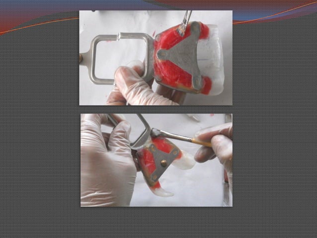 Gothic arch tracing.complete denture denture | PPT