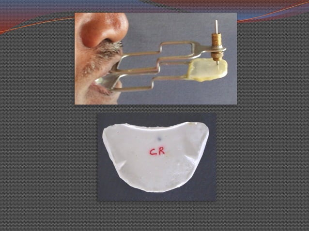 Gothic arch tracing.complete denture denture | PPT