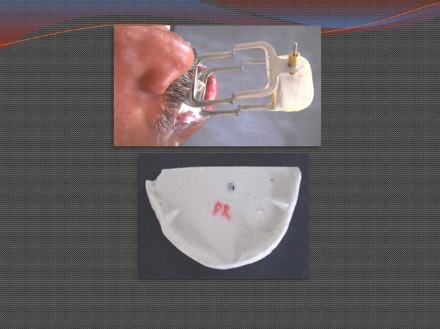 Gothic arch tracing.complete denture denture | PPT