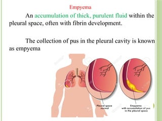 6. PLEURAL EFFUSION, EMPYEMA. power point tx | PPT